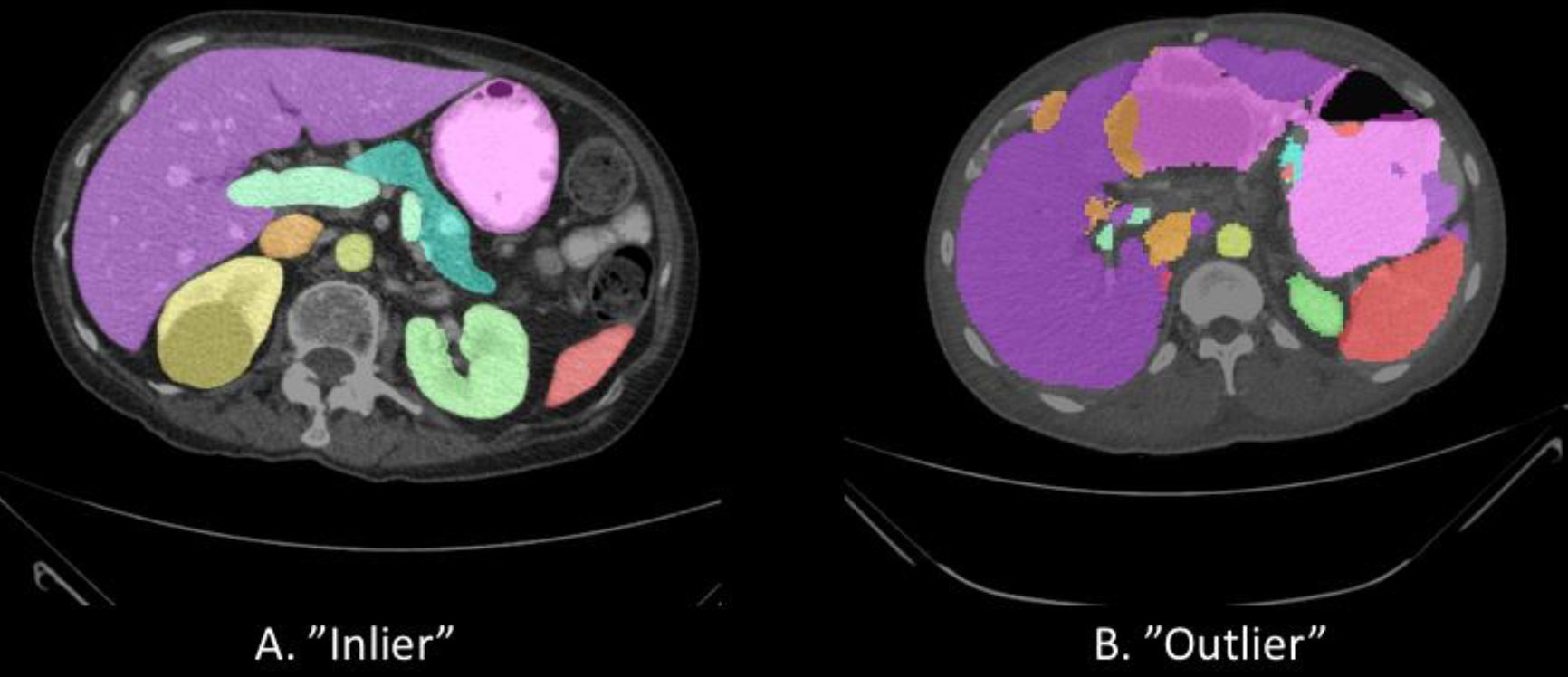 Outlier Guided Optimization of Abdominal Segmentation | Medical-image ...