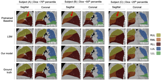Quantifying emphysema in lung screening computed tomography with robust ...