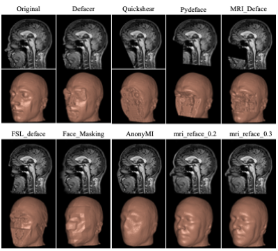 Reproducibility evaluation of the effects of MRI defacing on brain ...